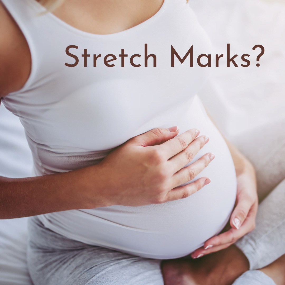 6 Interesting Facts (You Didn't Know) About Stretch Marks – Garden of EDEN